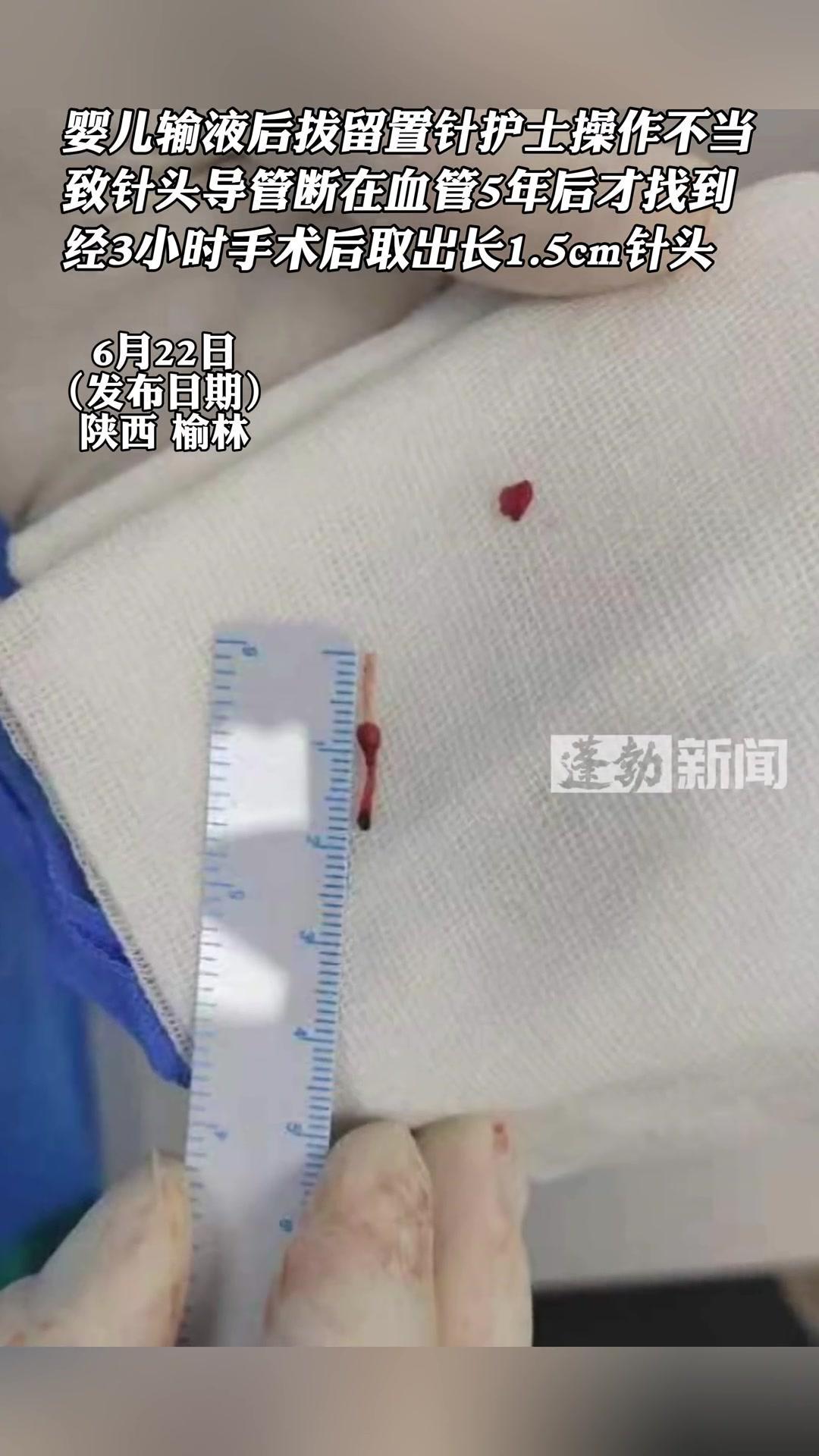 婴儿输液后拔留置针护士操作不当,致针头导管断在血管5年后才找到,经.
