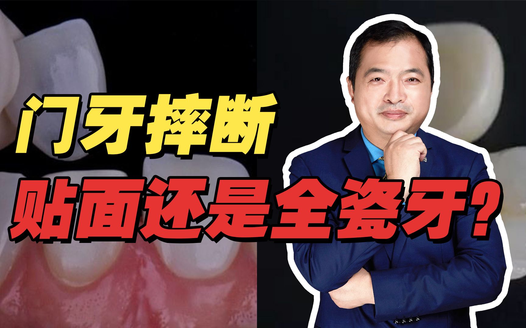 选择困难症请进,教你如何在贴面和全瓷牙中做出取舍。