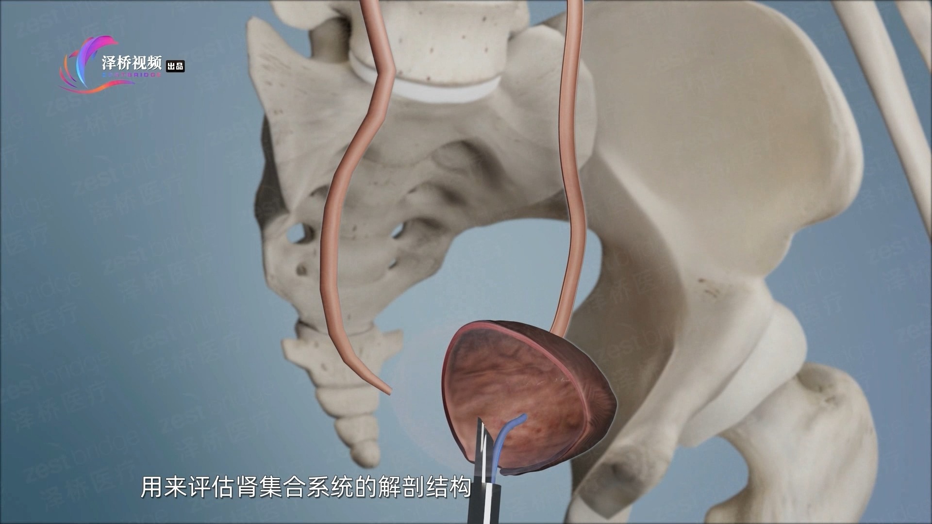 输尿管镜碎石术