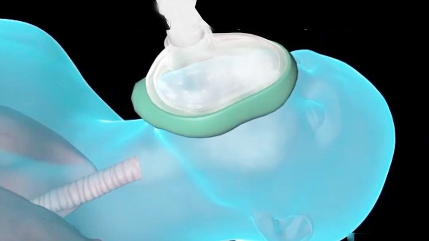 3D动画演示全身麻醉手术全过程,看上去并没想象的可怕