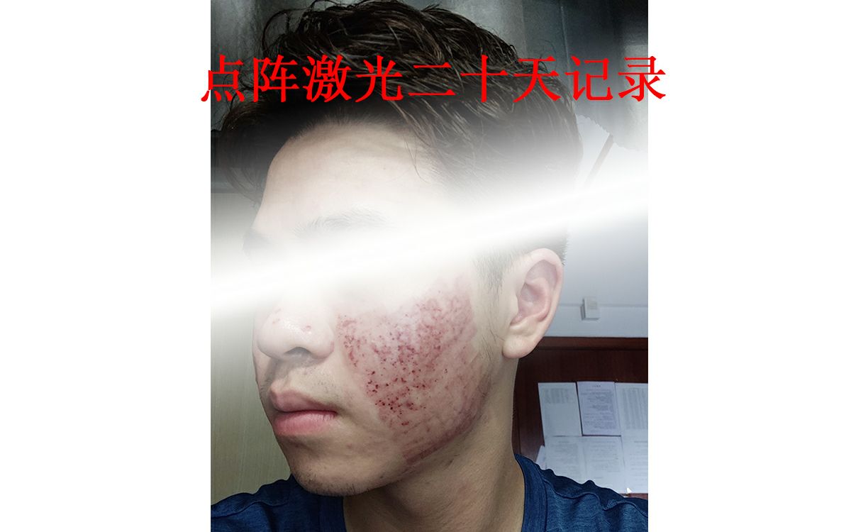 【痘印挑战】新人UP第一次尝试点阵激光祛痘印,二十天记录