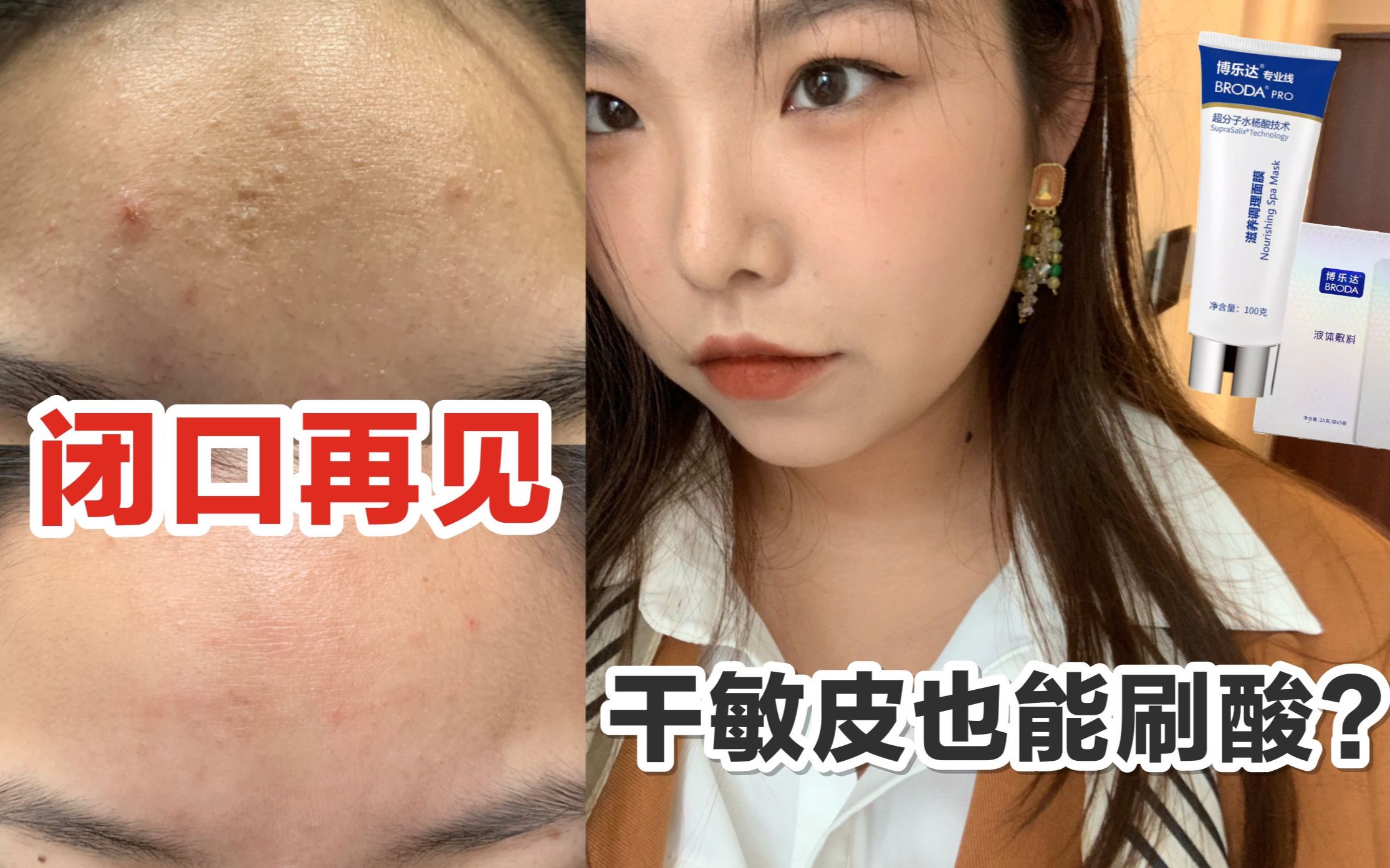 刷酸的快乐干敏皮也懂!敏感肌如何正确刷酸: 博乐达水杨酸使用方法、...