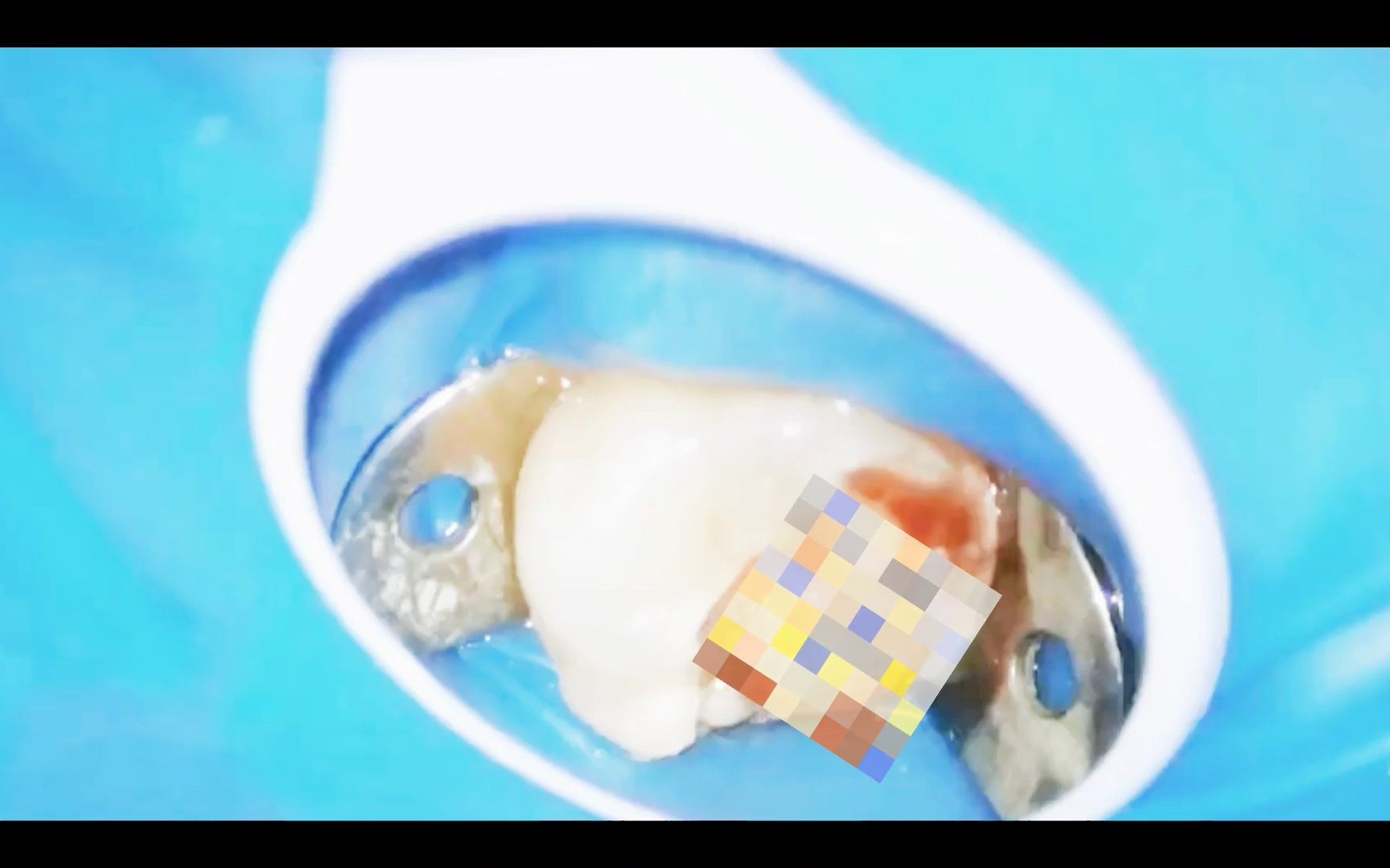 牙齿烂成这样,还能补吗?