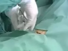 胸腔闭式引流