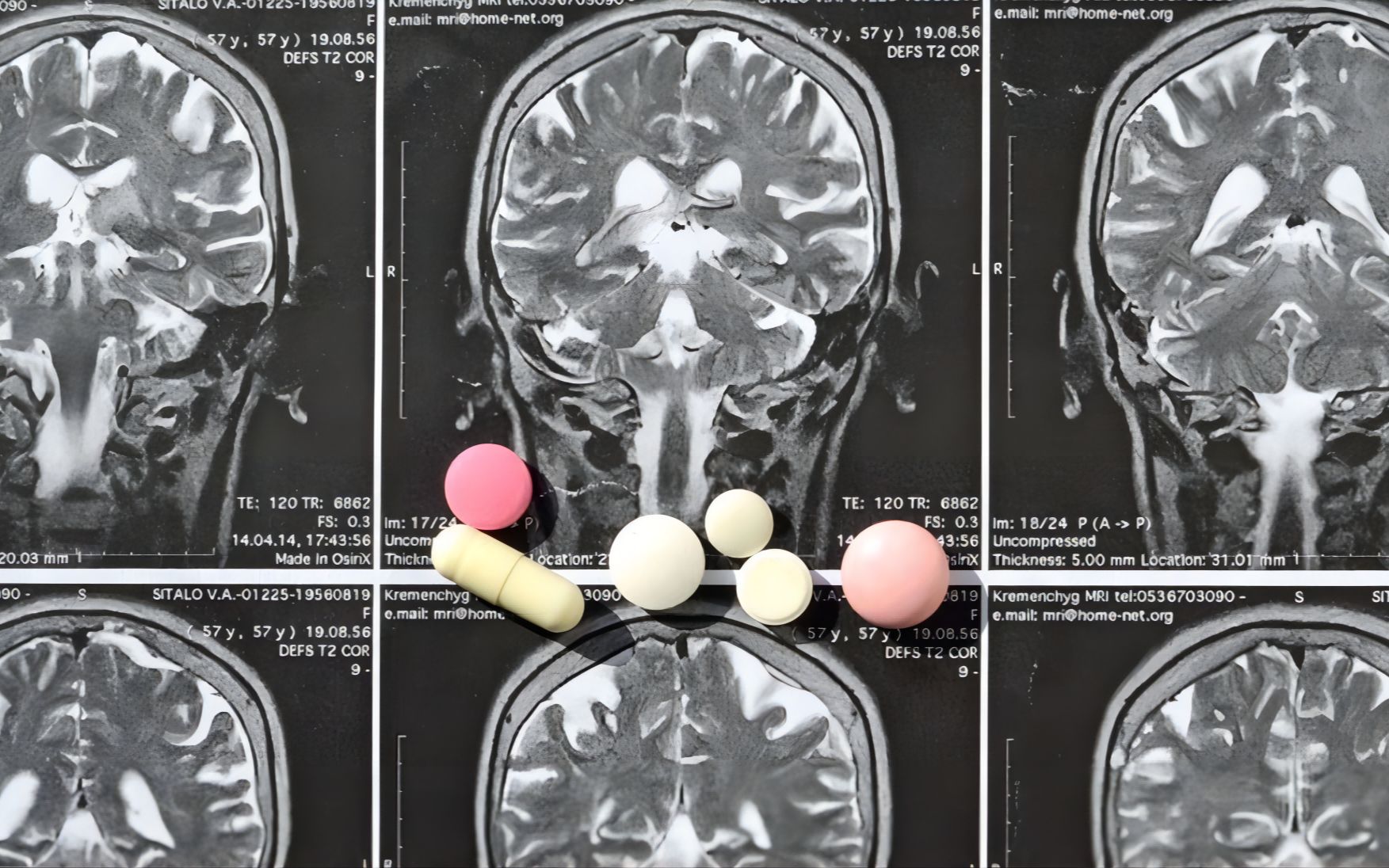 脑出血患者抑郁将导致血压升高@《Stroke》@麻省总医院@哈佛医学...