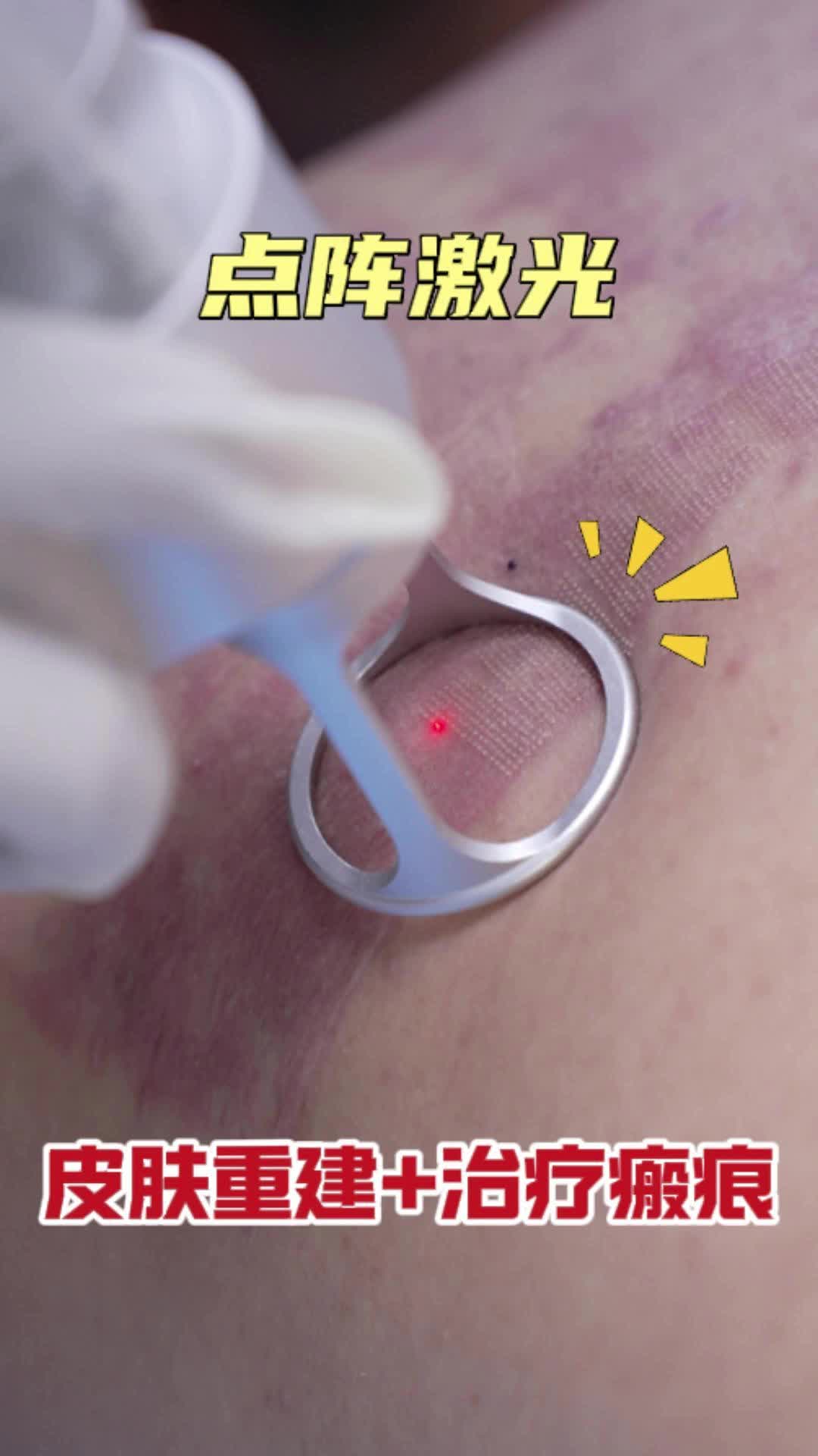 点阵激光改善瘢痕增生的原理