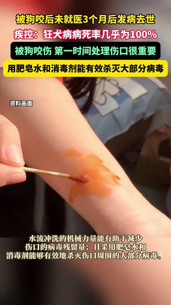 被狗咬后未就医3个月后发病去世,疾控:狂犬病病死率几乎为100!被狗...