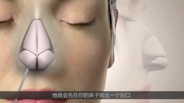 隆鼻手术到底有多疼?3D动画演示全过程,看完后背出冷汗