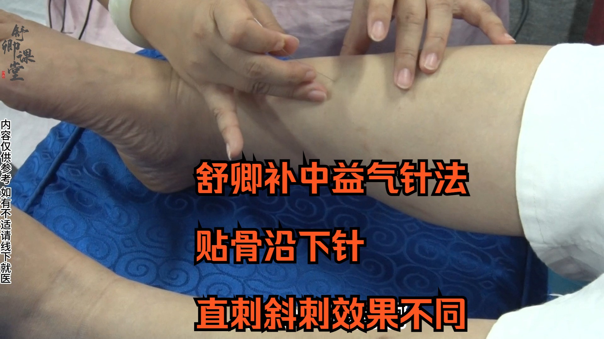 舒卿补中益气针法,贴骨沿下针,直刺斜刺效果不同