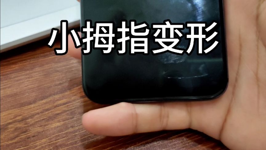 由于贵州某男子不停地不停地玩手机,最后小拇指变形