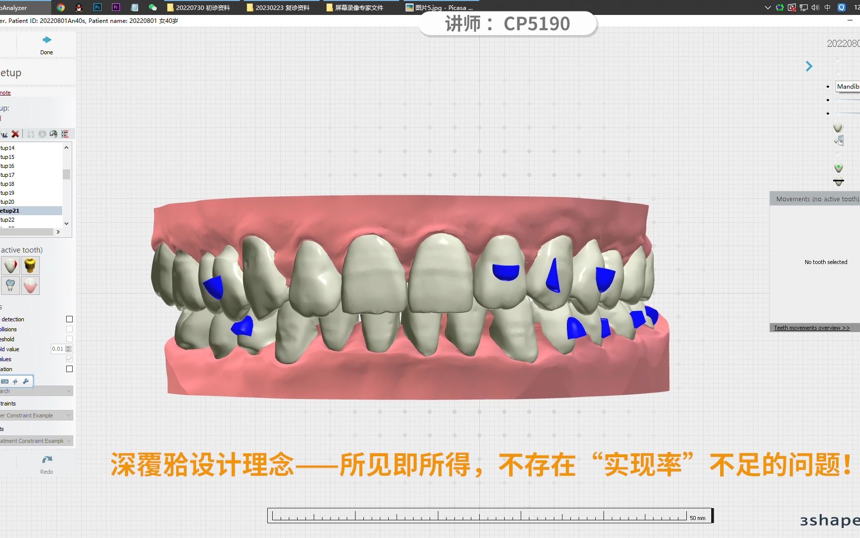 3shape隐形牙套设计,案例分析,Orthoanalyzer正畸模块软件操作02