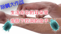 螨虫正在你皮肤上挖洞产卵,甚至是耳朵里!如何除螨很关键
