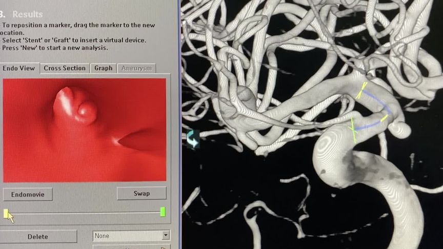 模拟血管内镜——那些个高级而无用的医学影像技术 #医学影像
