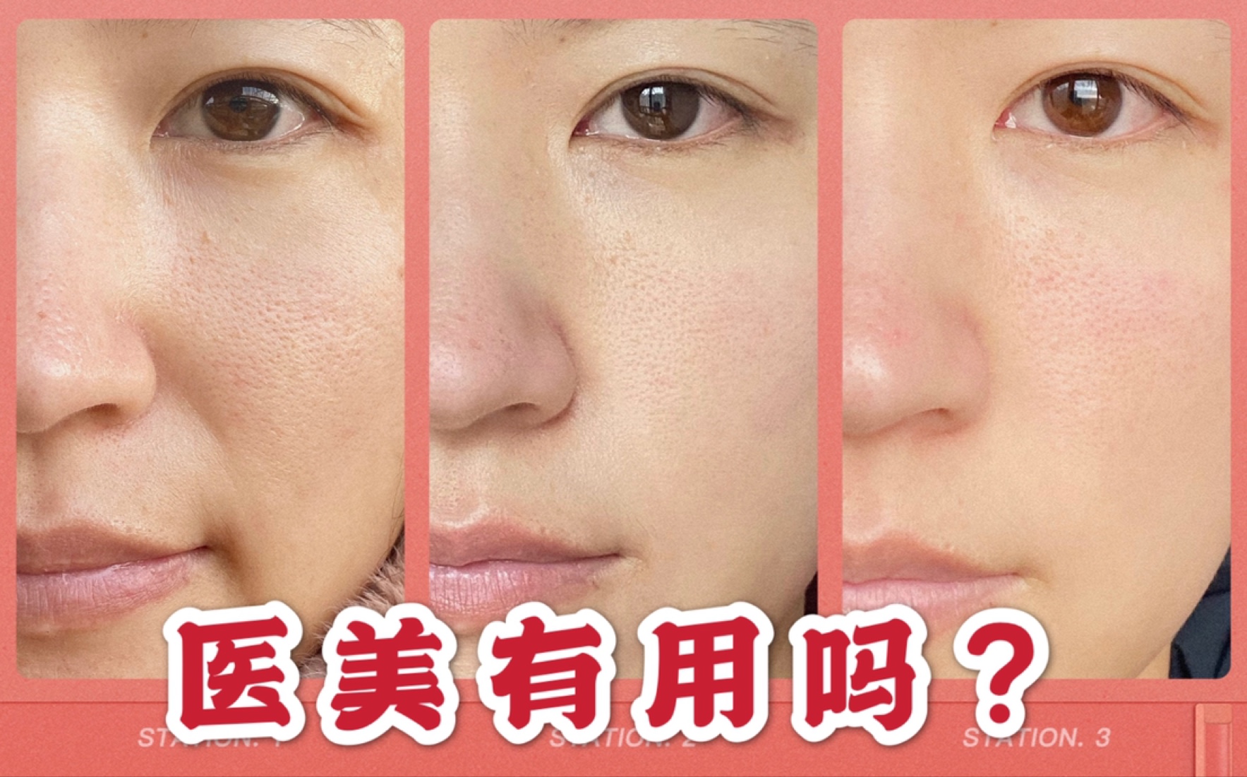【Lily】医美到底有没有用?纹路变浅了?年轻了?——超皮秒&蜂巢皮秒...