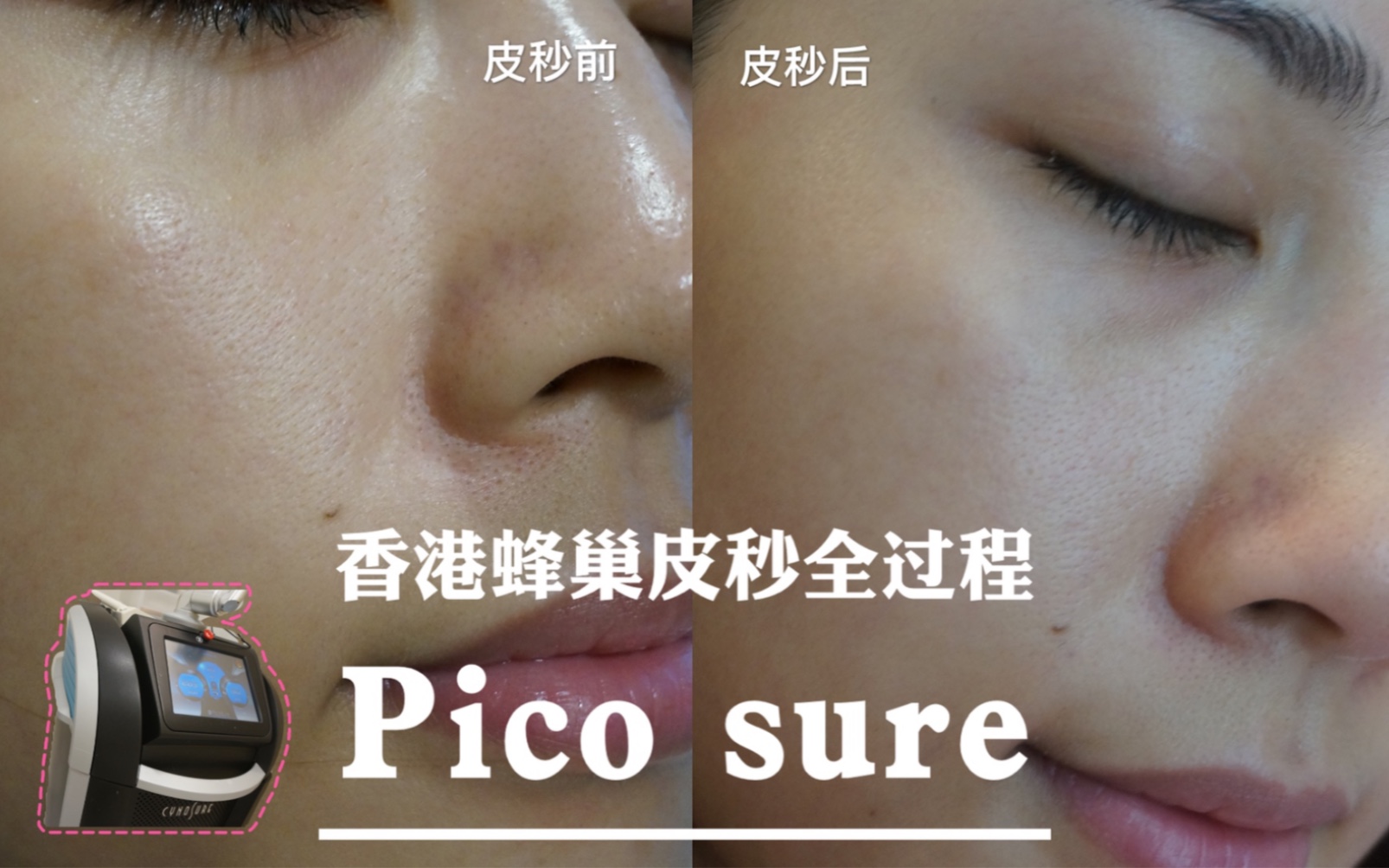 ...Sure体验全过程(内含价格)/蜂巢皮秒Pico Sure和超皮秒Pico Way区别