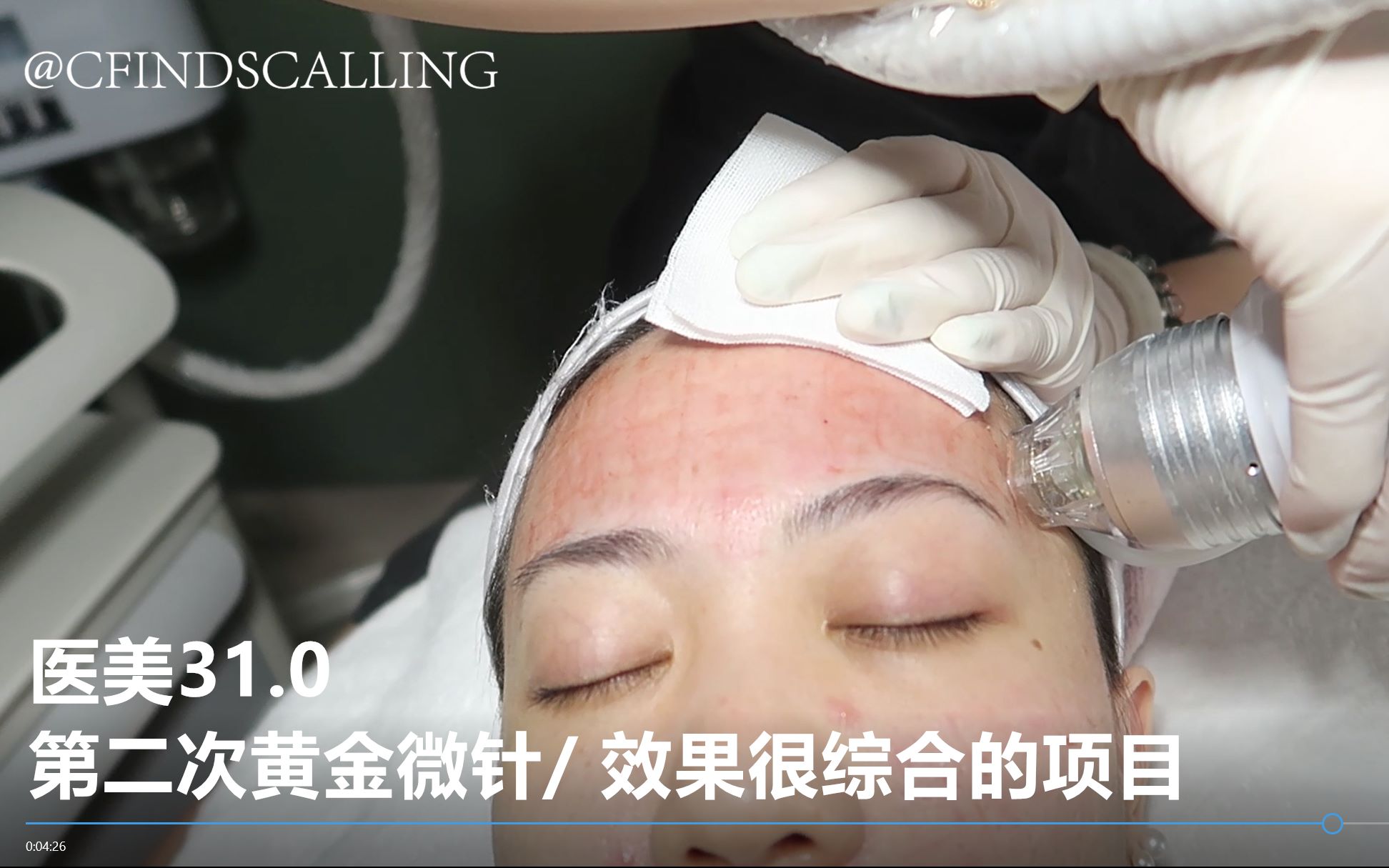 医美31.0/ 第二次黄金微针射频/ 既是射频又是微针?/ 效果很综合的项目