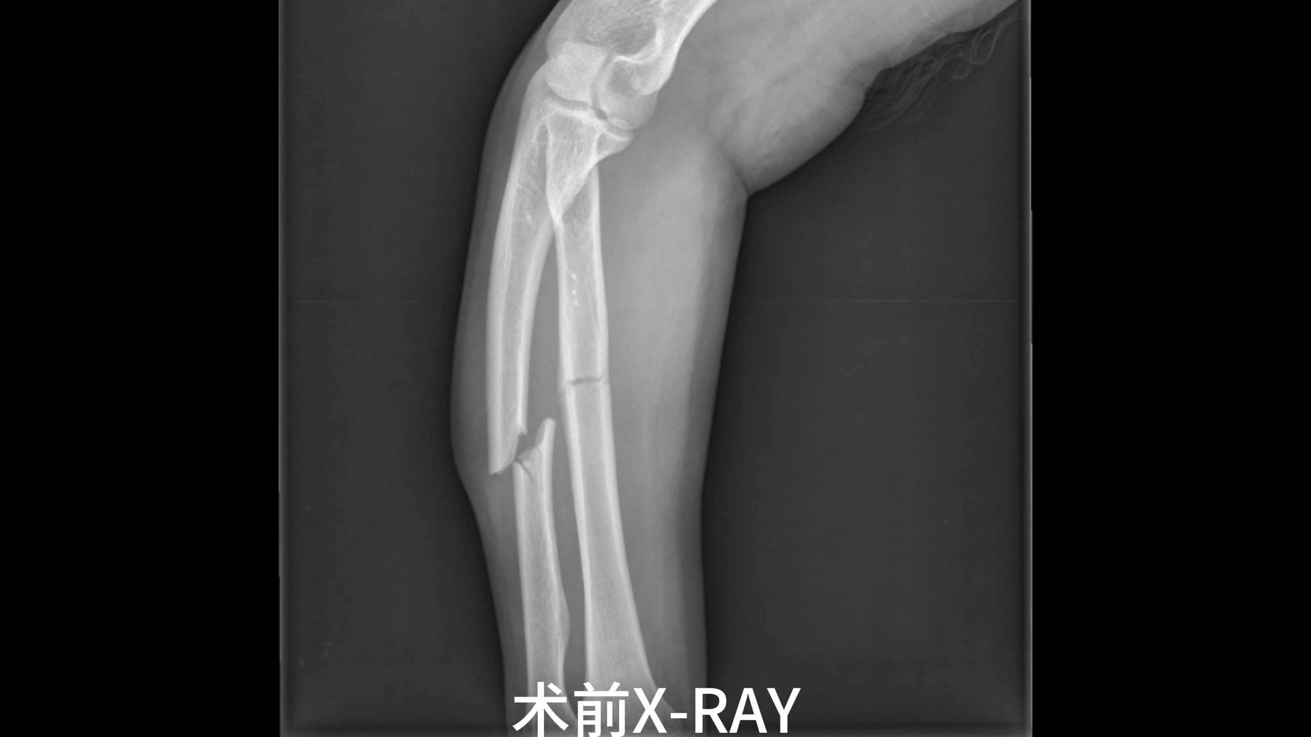 手术教学视频:尺桡骨骨折切开复位钢板内固定术