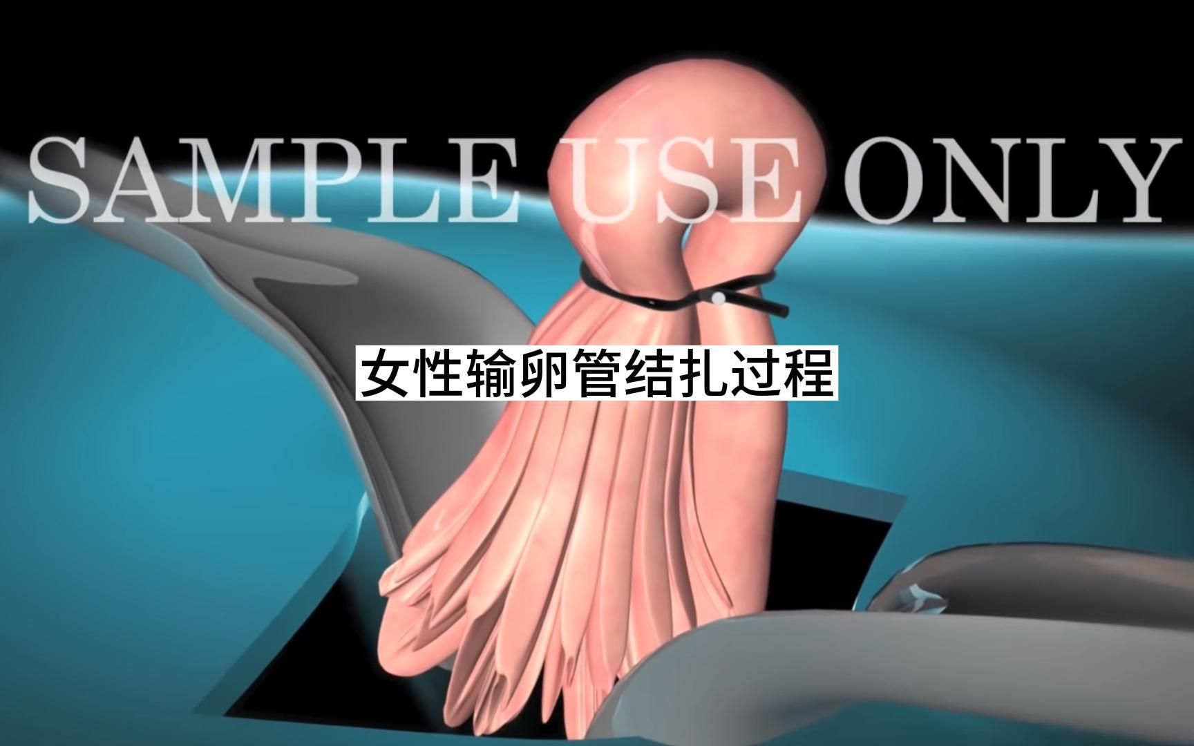 3D画面展示女性输卵管结扎手术全过程