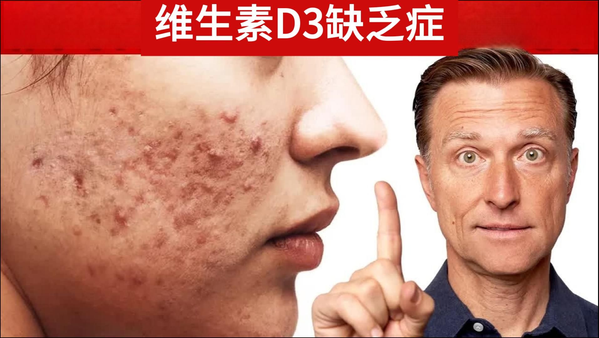 【配音】痤疮最常见的维生素缺乏症,柏格医生