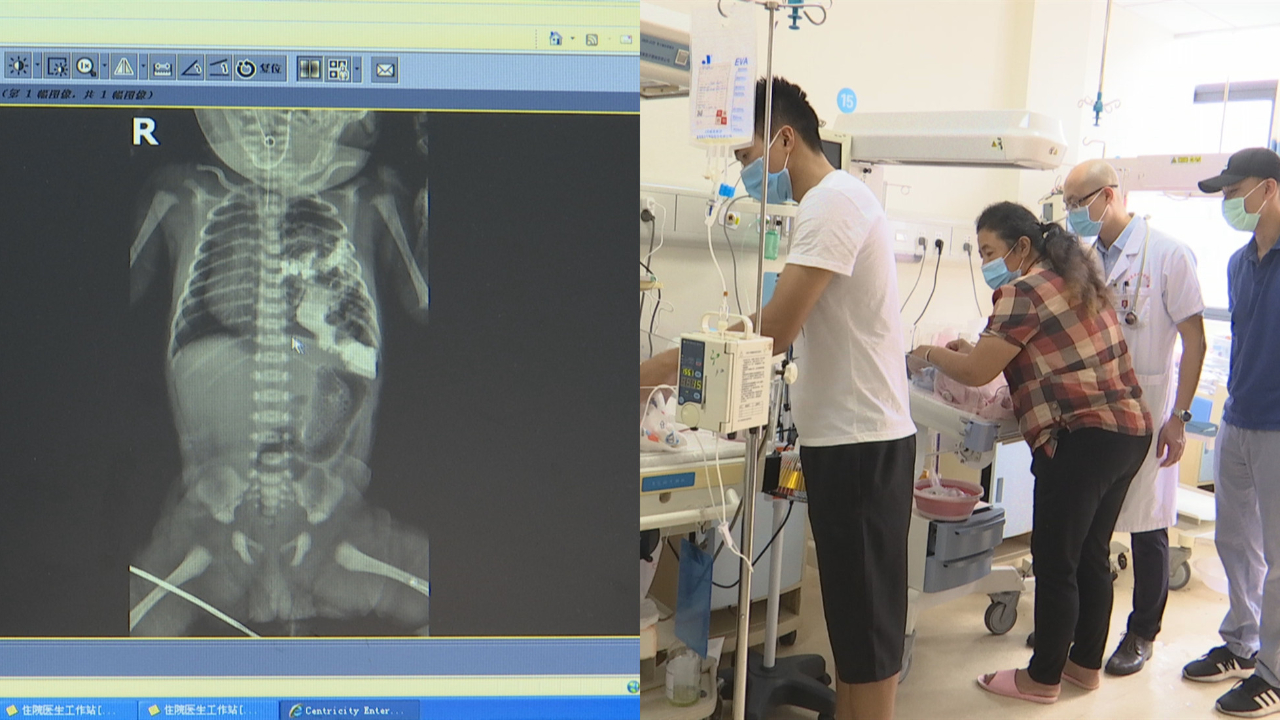 婴儿患先天性疾病,刚出生肠子外露,险丧命