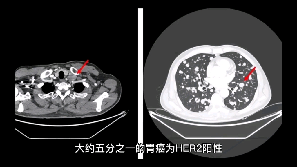 HER2阳性晚期胃癌新药Enhertu(DS8201)中文用药说明