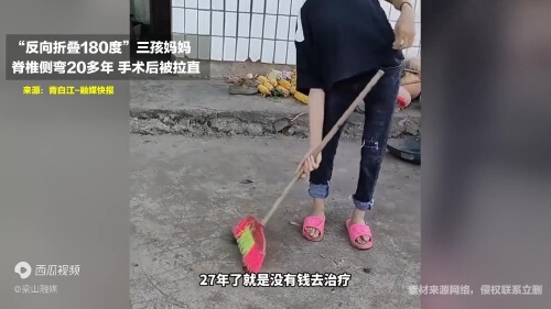 "反向折叠180度"三孩妈妈,脊椎侧弯20多年,手术后被拉直