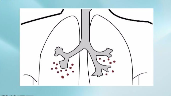 哪些人最容易感染上肺结核?医生说这几类高危人群要当心