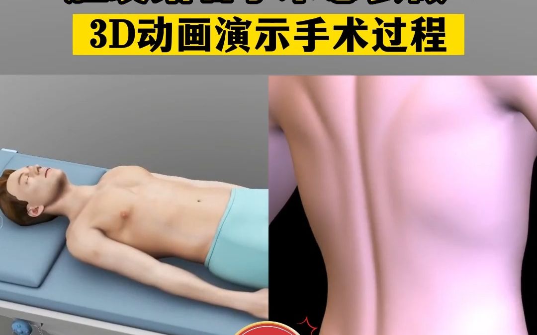 3D动画演示胆囊结石手术过程