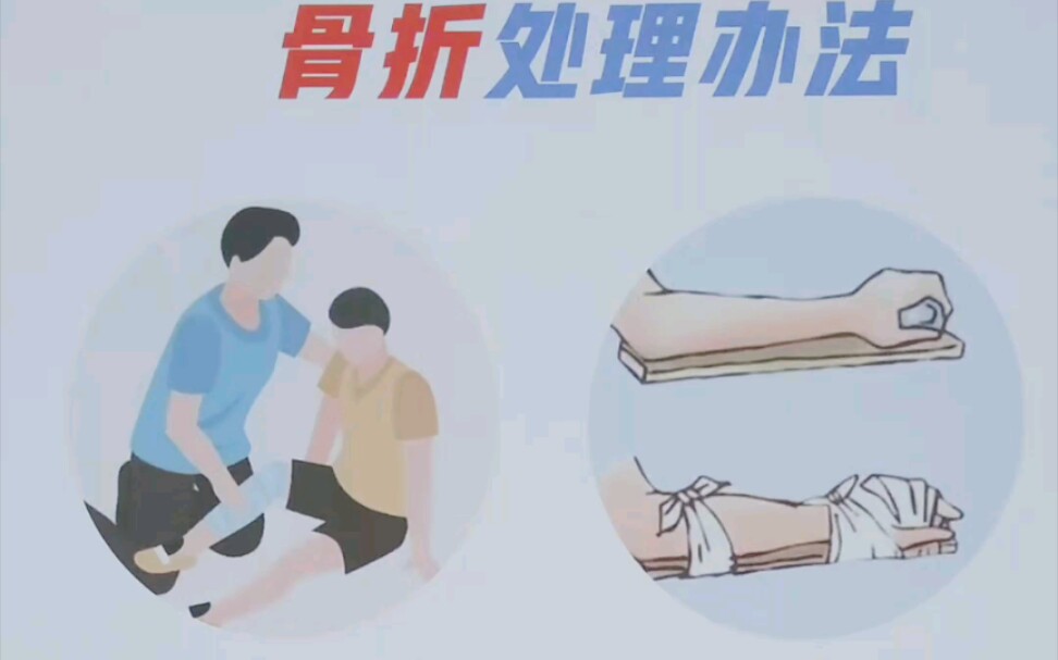 【急救知识宣传】骨折处理办法