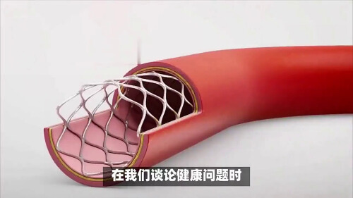 一个小小的"心脏支架",为何卖的那么贵?它的工作原理是什么?