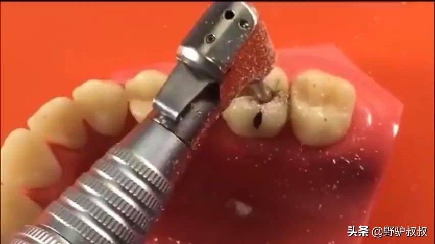 牙医是如何进行蛀牙龋齿牙齿修复的,3分钟了解操作全过程
