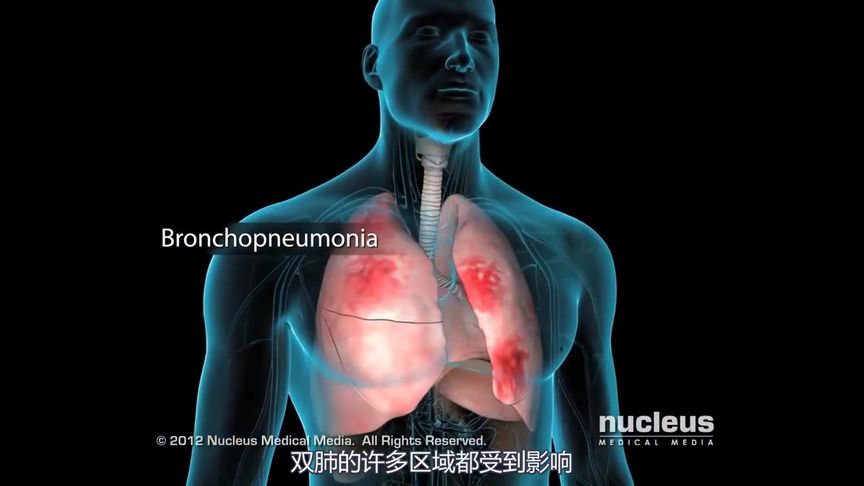 医学3D动画演示:肺炎是如何影响我们的肺功能和身体的?