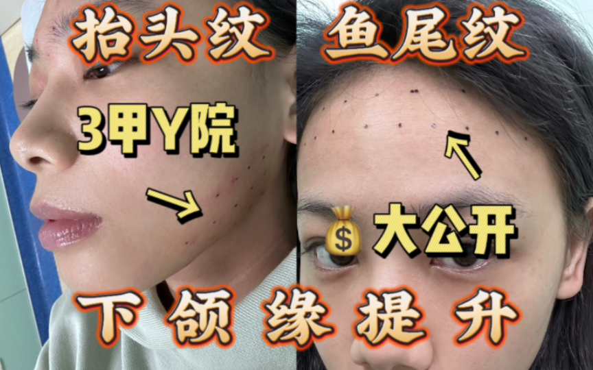 【肉毒除皱记录】制定方案!费用!看完这篇再行动!