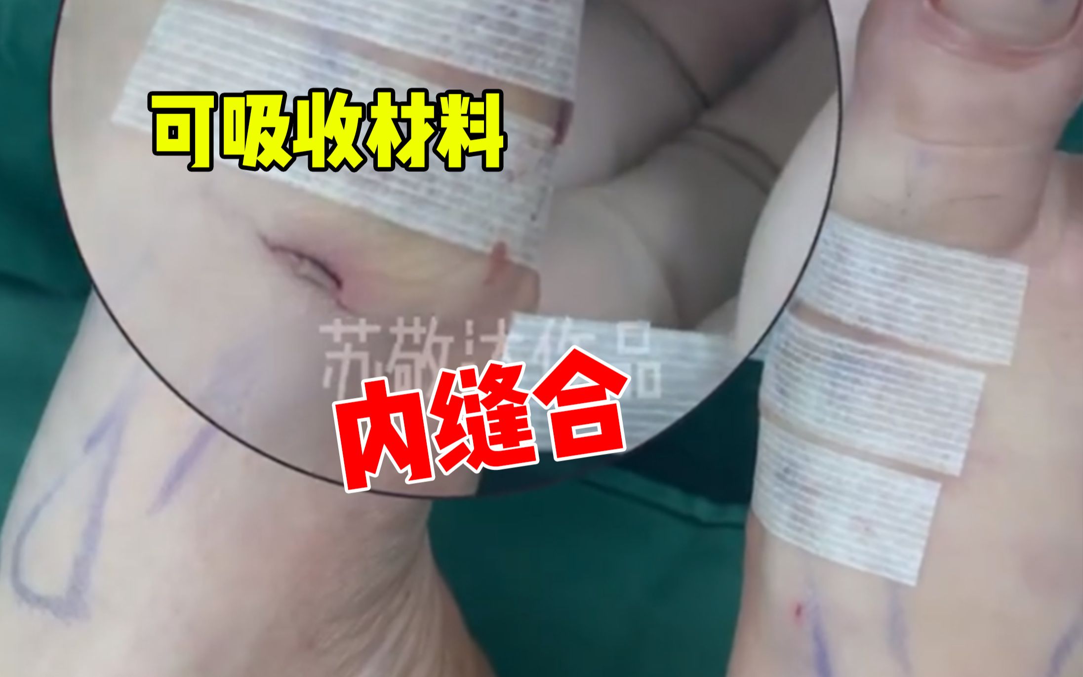 【苏敬达】做拇外翻手术不用拆线了?35岁女士术后直呼“简直!太奇迹...