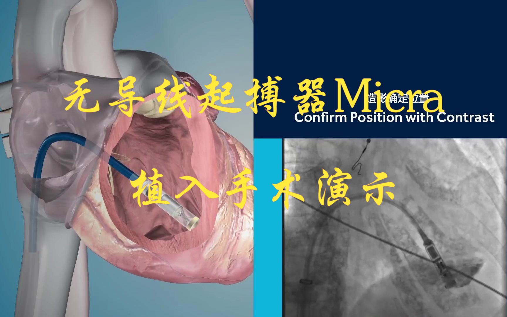 无导线起搏器Micra植入手术演示