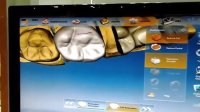德国Sirona(西诺德)CAD(电脑辅助设计)Inlab(试验室技术)