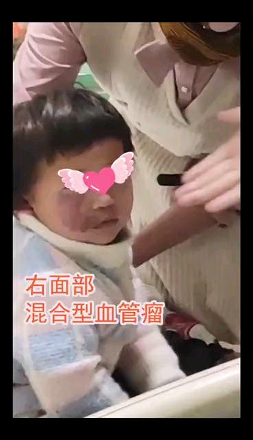小女孩右面部有大面积混合型血管瘤,经过一