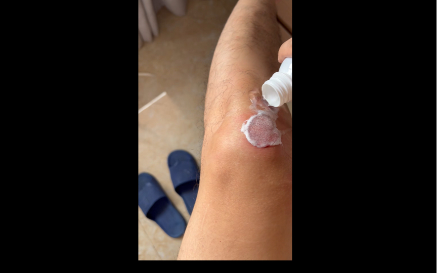 双氧水冲洗伤口