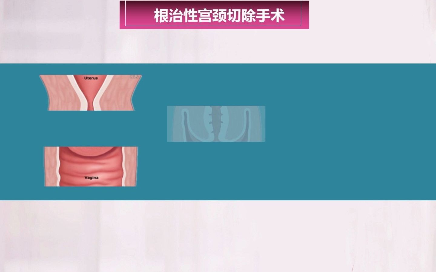 PPT制作医学课件--根治性宫颈切除手术示意动画