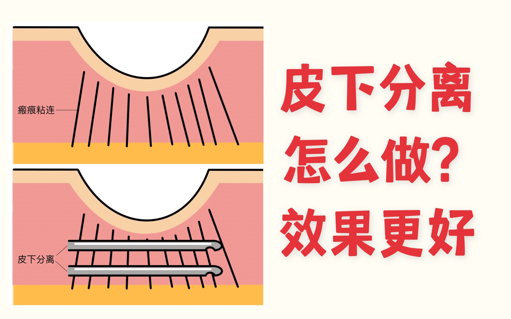 严重痘坑的皮下分离怎么做效果更好?更彻底?