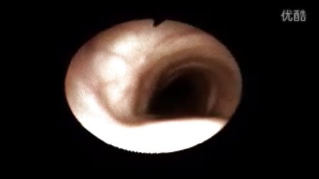 Fiberoptic Intubation(支气管镜插管)