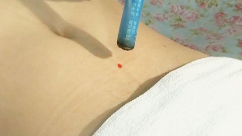 古人强身健体的妙法——艾灸关元穴