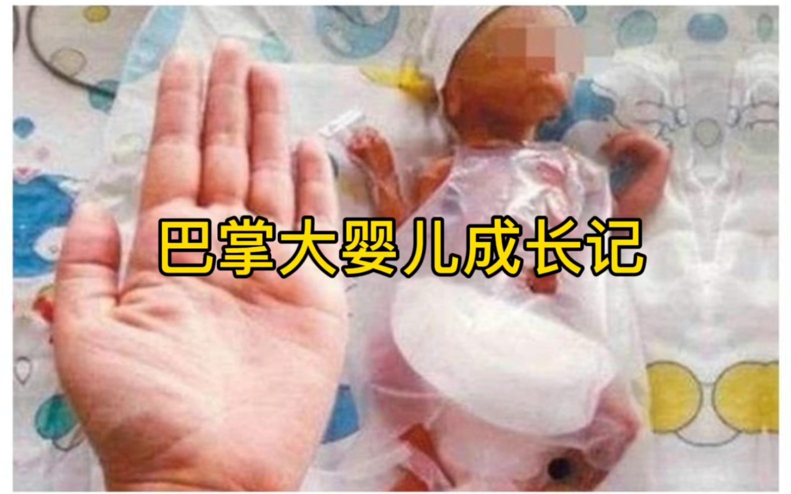 巴掌婴儿历经700多次抢救,战胜19种疾病,蜕变奇迹男孩。