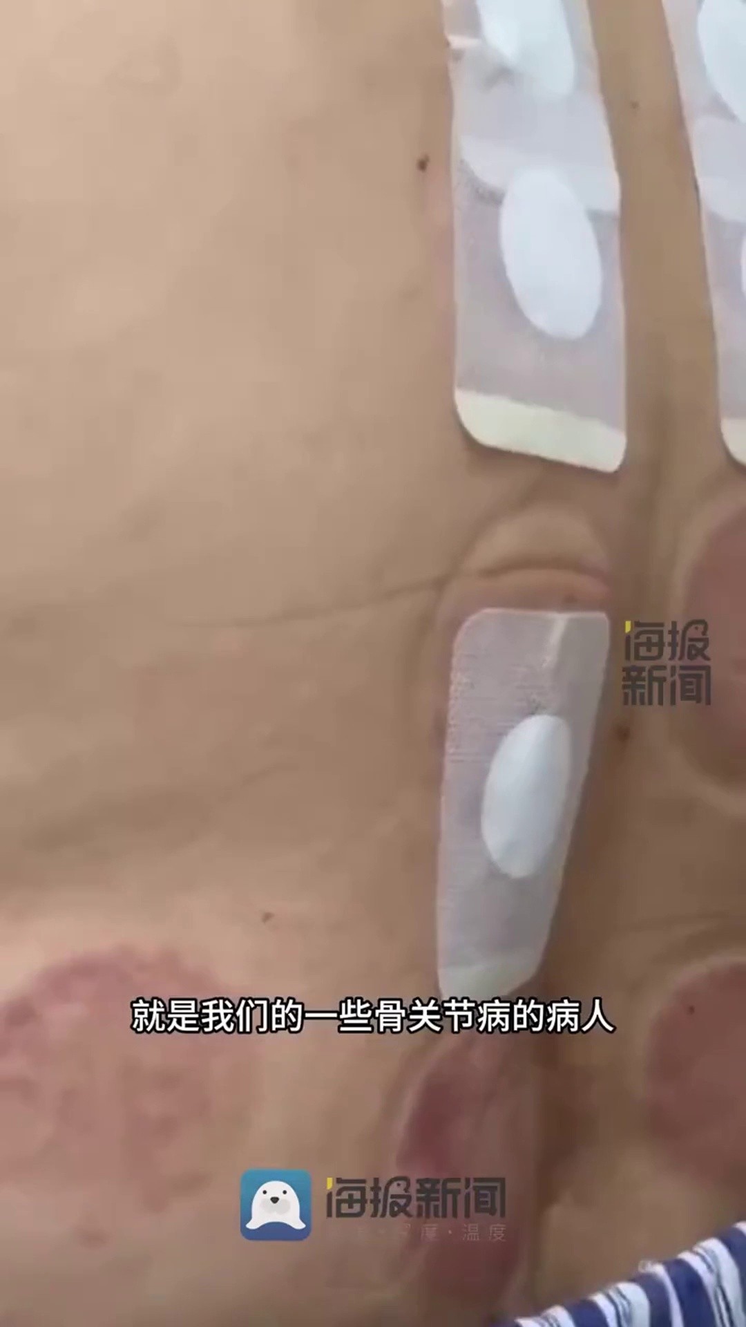 "三伏贴"的适宜人群有哪些?贴敷一定要入伏当日吗?