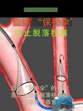 血栓保护伞 《血栓"保护伞"防止血栓脱落》 3D动画方式展示保护机理 ...