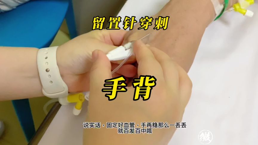留置针穿刺日常分享…手背#留置针 #护士
