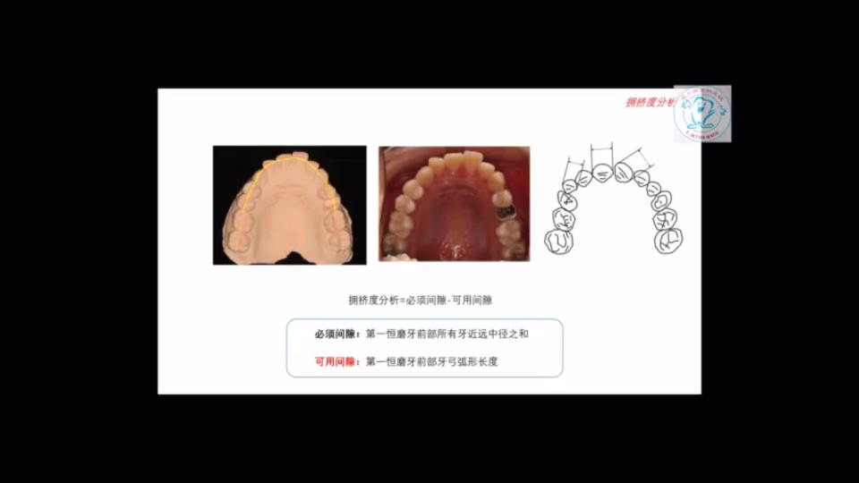 赵高峰老师正畸模型分析