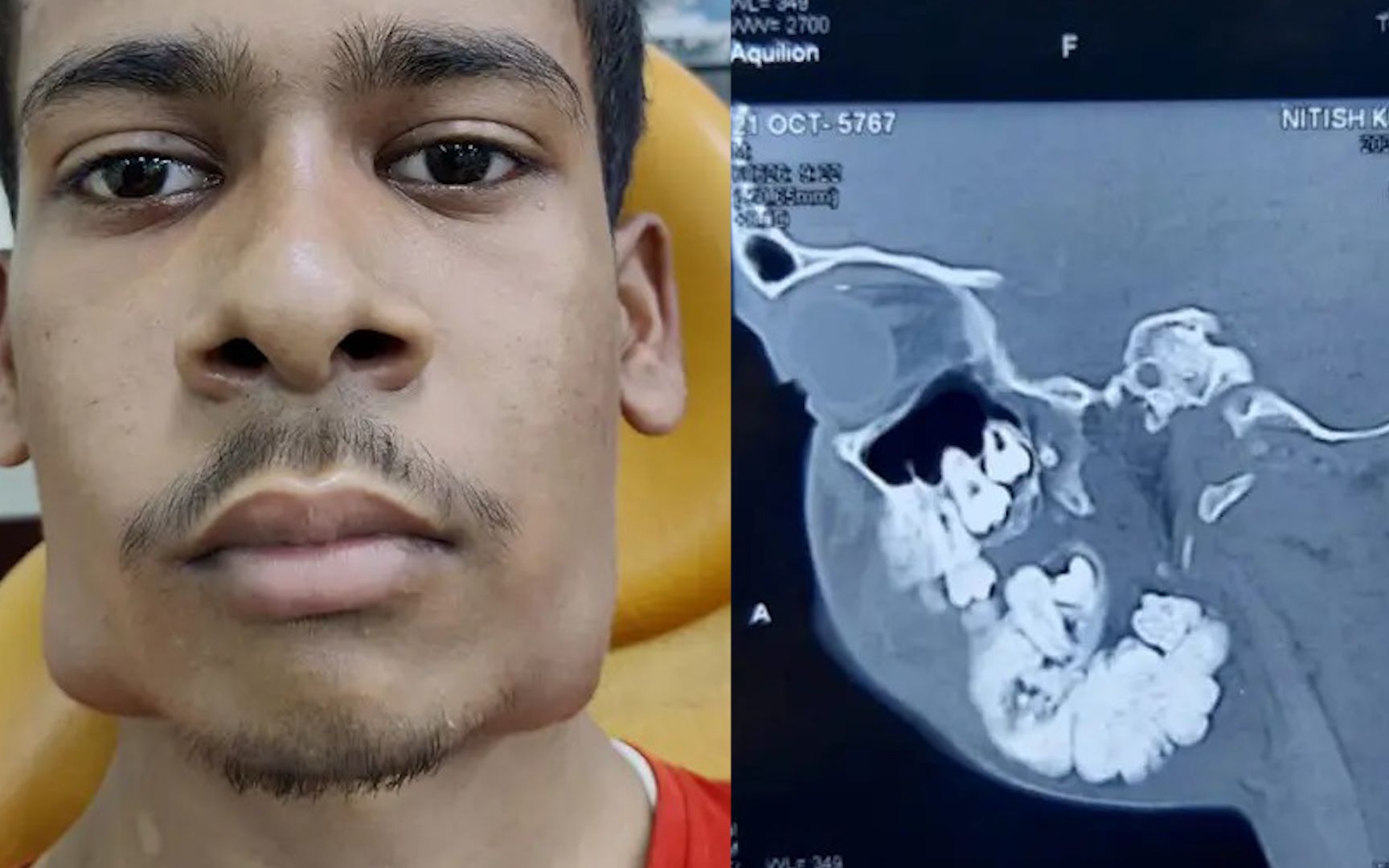 印度小伙下口腔长了82颗牙,医生为了治疗耗时三小时将其拔光