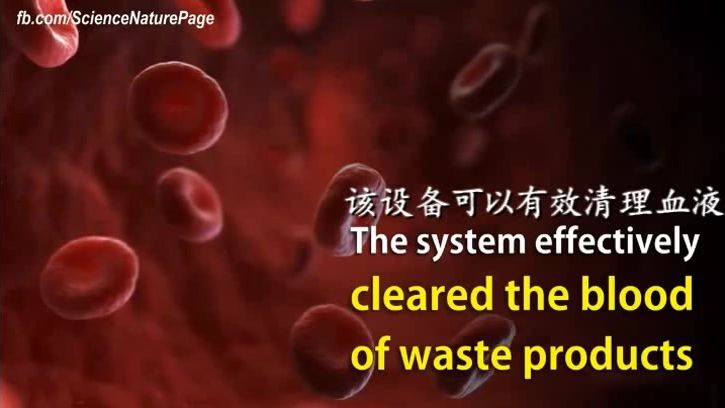 未来医疗技术之二:可穿戴的透析机,肾衰患者的福音