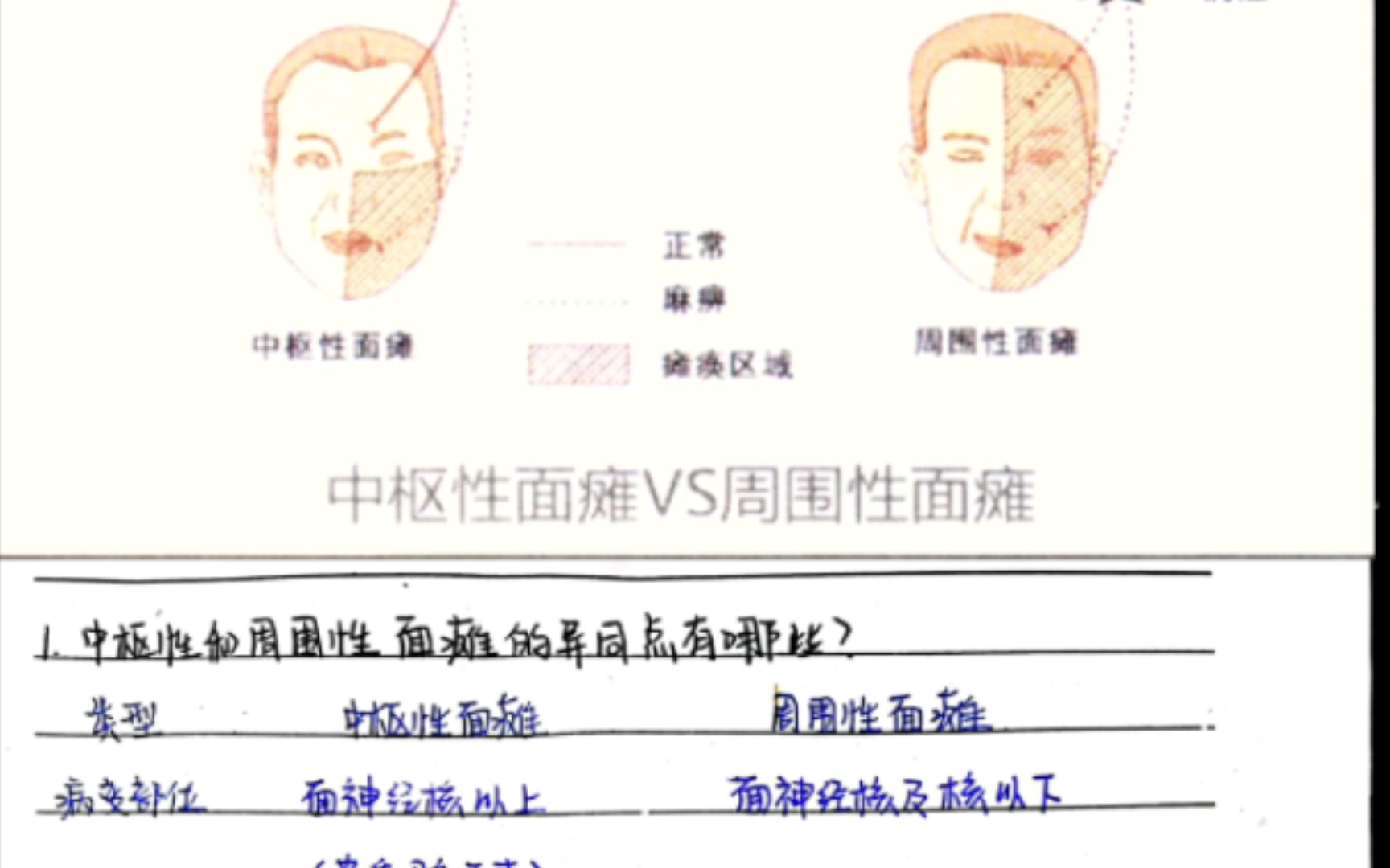 【神经病学】中枢性面瘫与周围性面瘫对比